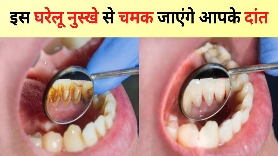 Teeth Whitening Tips Home Remedies In Hindi Pile Dant Kaise Saaf Kare