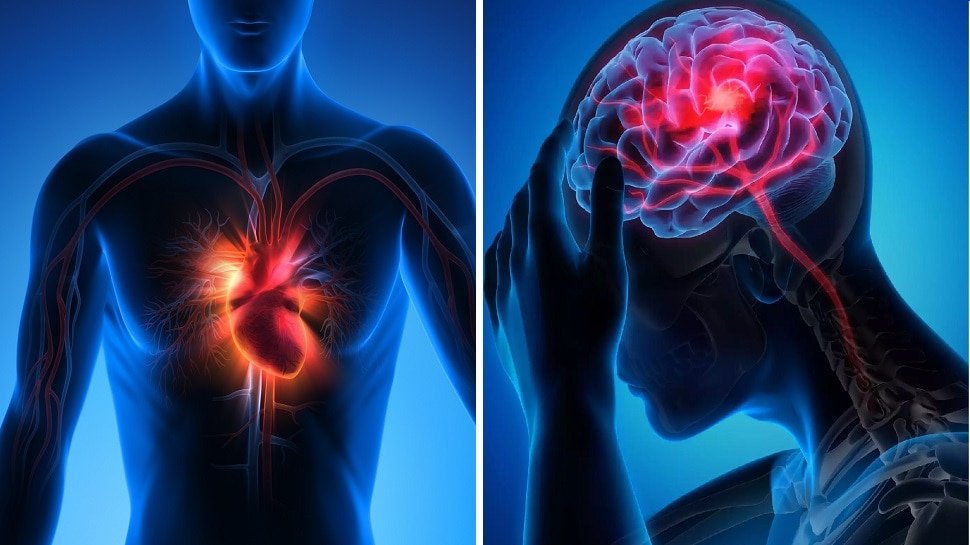 Heart Attack Vs Stroke What Is Difference Between Heart Attack And Heart Attack Vs Stroke What Is Difference Between Heart Attack And