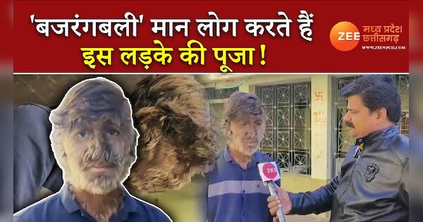Werewolf Syndrome Boy face covered with hair look like Hanuman Ratlam ...
