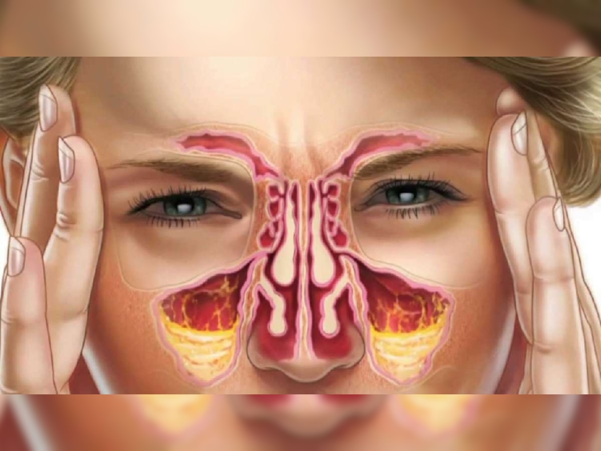 Health News fungal infection in nose sinuses know symptoms prevention ...