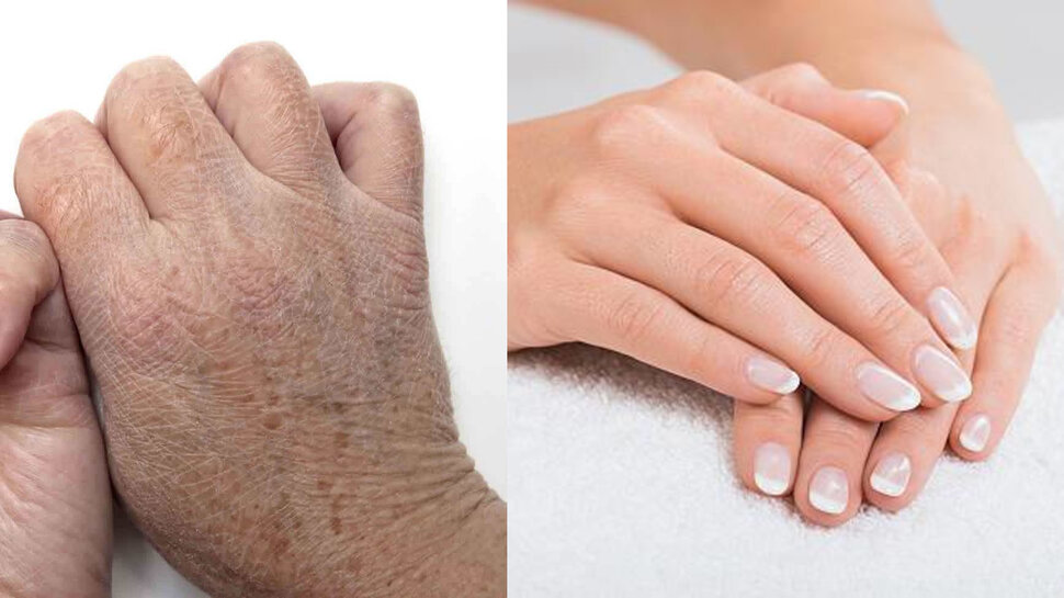 winter hand care home remedies stop the cracking hands hath fatne ke ...