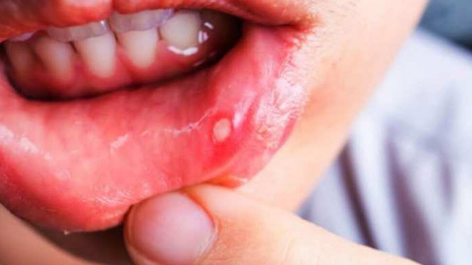 Mouth Ulcer Home Remedies What To Do In Mouth Ulcers Mouth Ulcer Home Remedies मुंह में बार