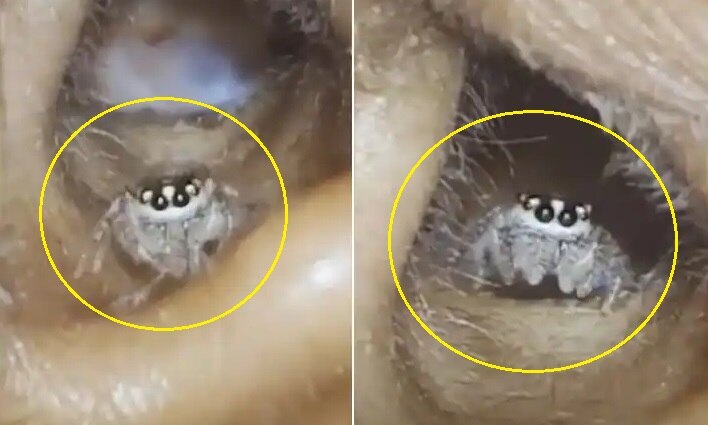 shocking video of little spider raoming inside the ear of woman on ...