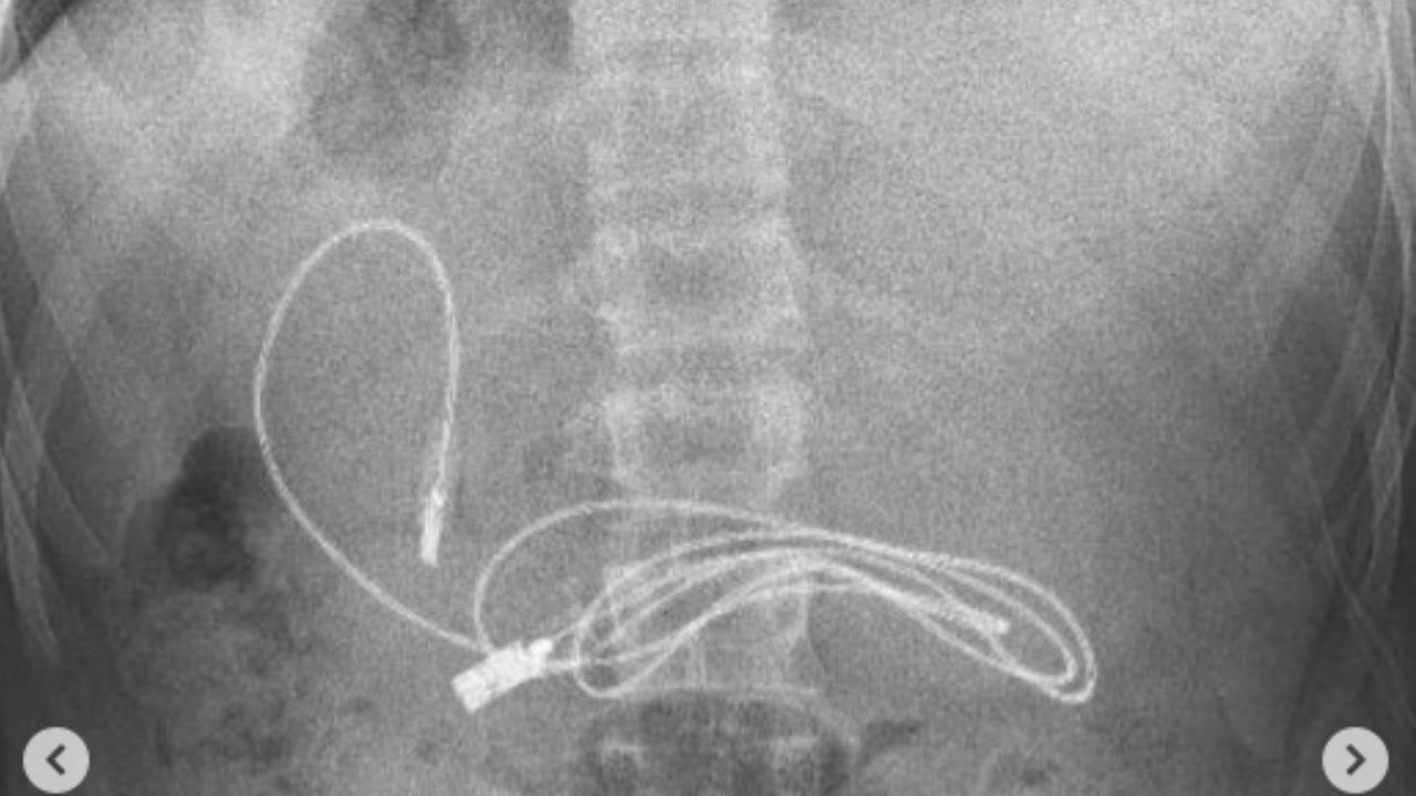 Troubled child reached hospital with severe stomach pain doctors found ...