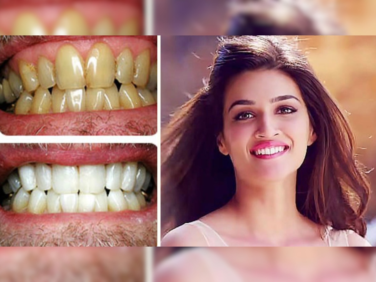 Kriti Sanon Smile How To Get Rid Of Yellow Teeth Whitening Mustard Oil ...