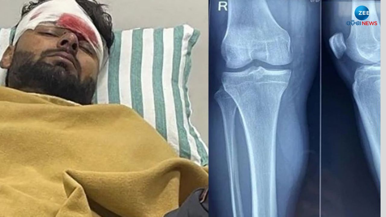 Indian Cricketer Rishabh Pant Accident Rishabh Pant Health Update knee ... Indian Cricketer Rishabh Pant Accident Rishabh Pant Health Update knee ...