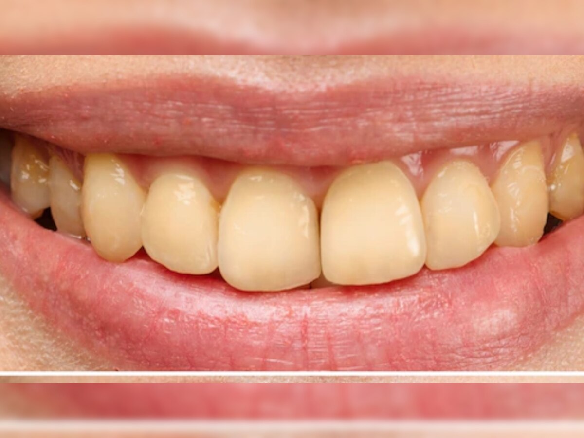 home remedies to get rid of yellow teeth problem get deepika like white ...