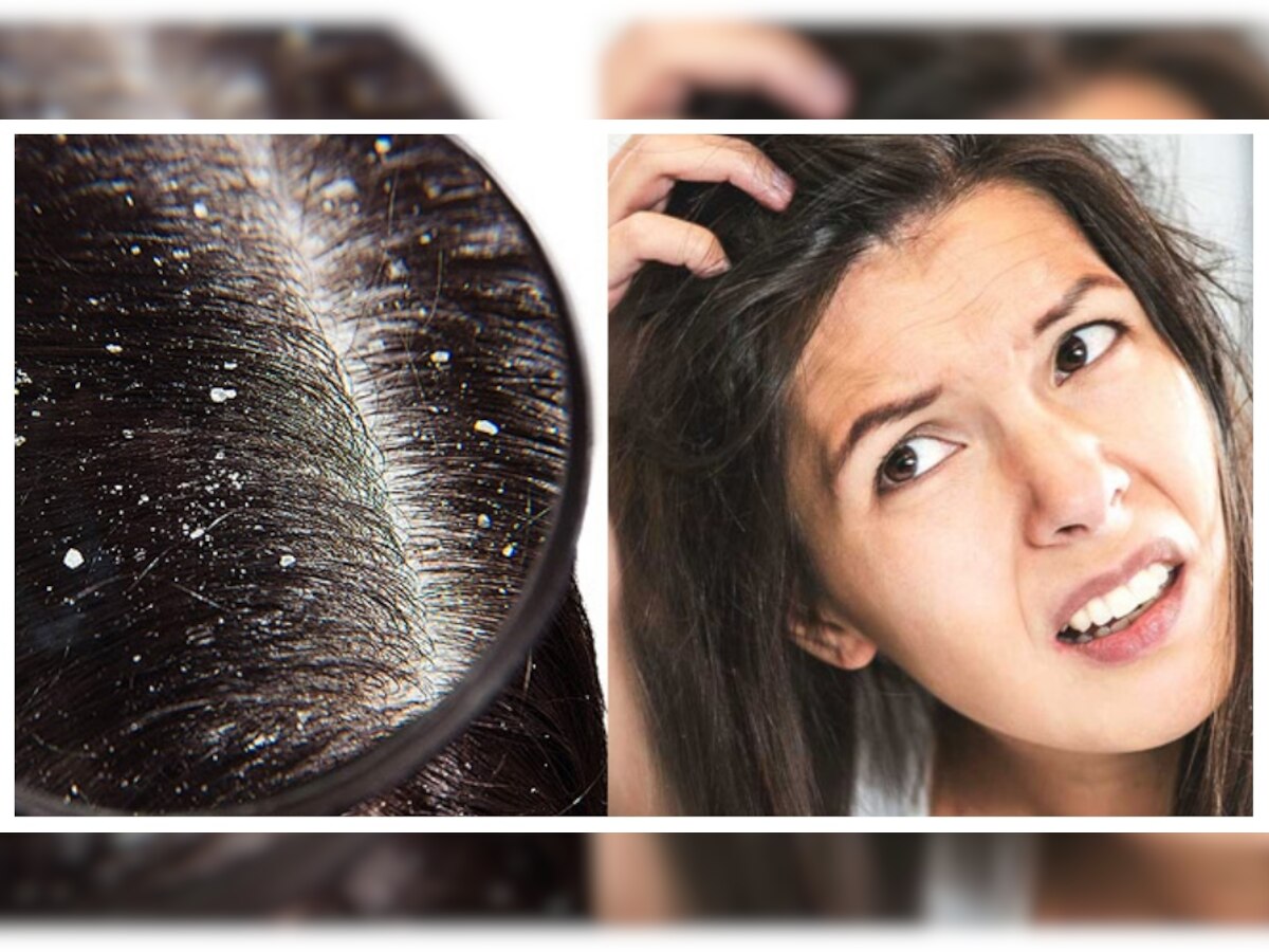 health tips home remedies to get rid of dandruff in winter| Hair Care ...
