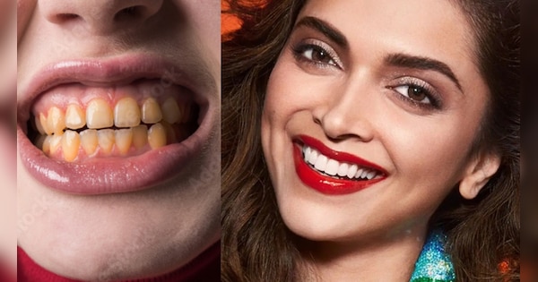 teeth Whitening home remedies yellow teeth problem peele dant | Teeth ...