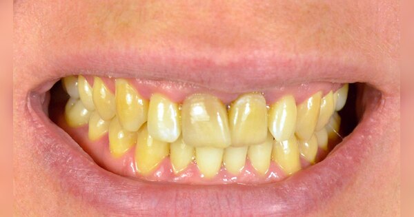 Yellow Teeth Solution How to Clean Yellow Teeth | Yellow Teeth: पीले ...