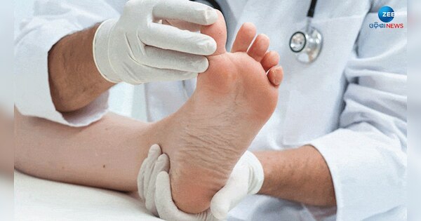 diabetic foot care tips control sugar level foot ulcer symptoms and treatment