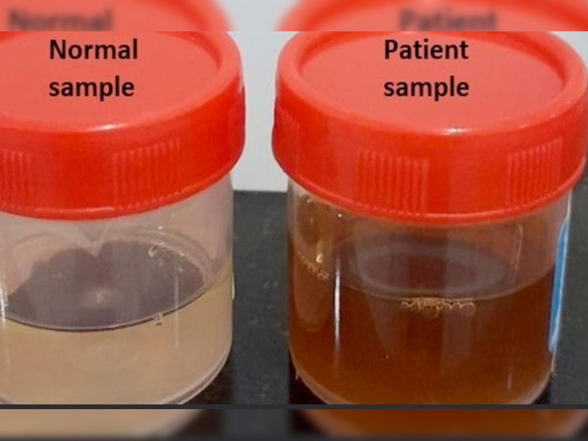 Urine Colour: ପରିସ୍ରାର ରଙ୍ଗରୁ ଜଣାପଡ଼େ ଆପଣଙ୍କ ସ୍ବାସ୍ଥ୍ୟବସ୍ଥା, ଜାଣନ୍ତୁ ...