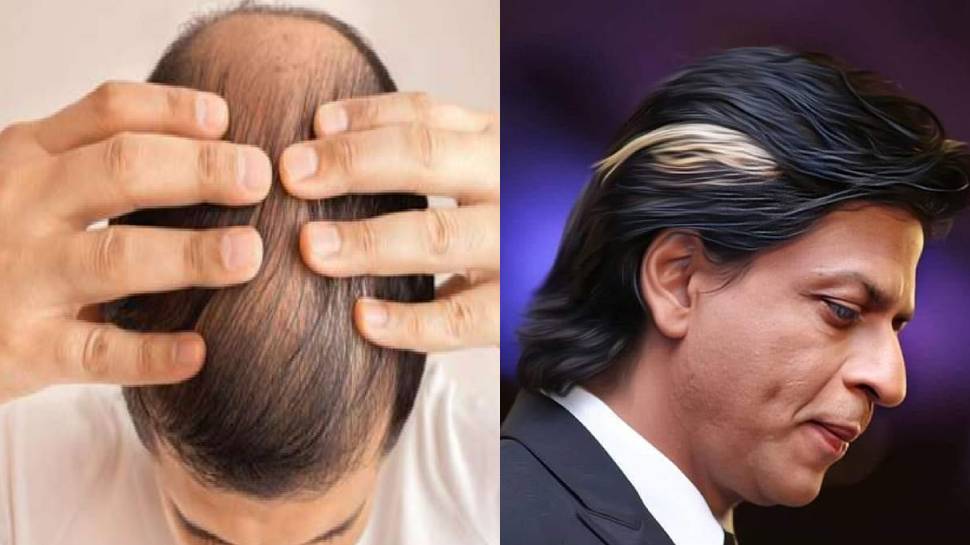 Hair Transplant keep these things in mind to remove baldness and get a ...