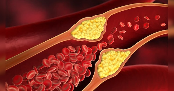 High cholesterol can damage heart know what happens in your body when ...