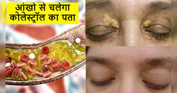 High Cholesterol can cause Yellow Lumps Deposits Near Xanthelasma Eyes ...