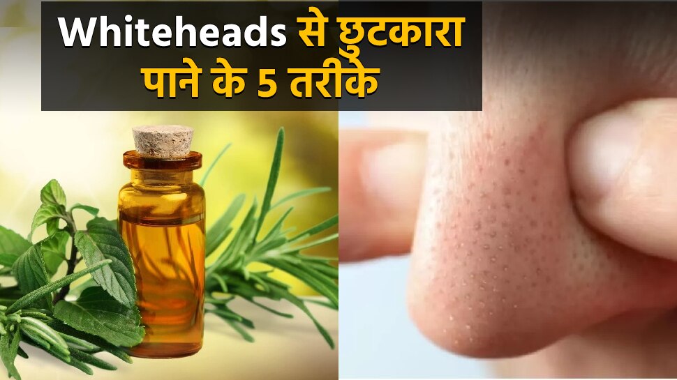 Whiteheads suppress the beauty of face try these 5 methods to get rid of Whiteheads | Whiteheads ...