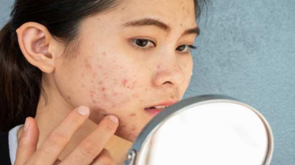 this is the main reason of pimples coming again and again on face leave ...