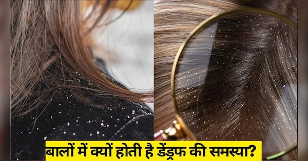 what are the causes of dandruff in hair dandruff problem solution ...
