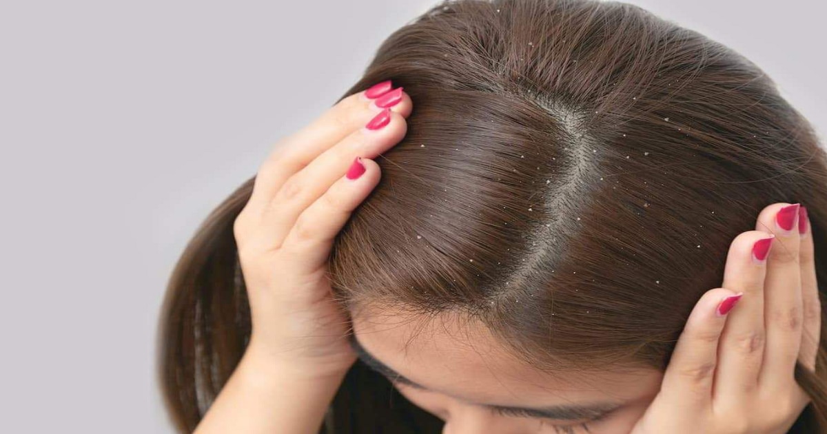 Hair Dandruff Causes Symptoms Diagnosis Treatment Prevention and Remedies