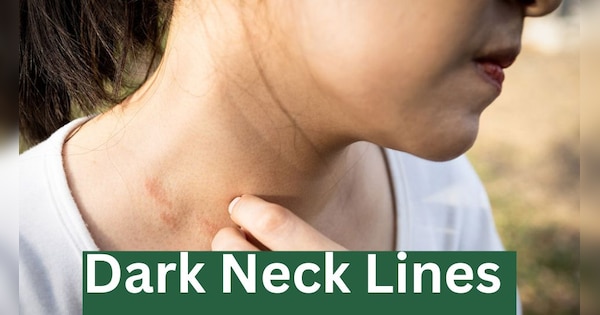 Dark Circles On Neck Line could be Warning Sign Of Prediabetes Never ...