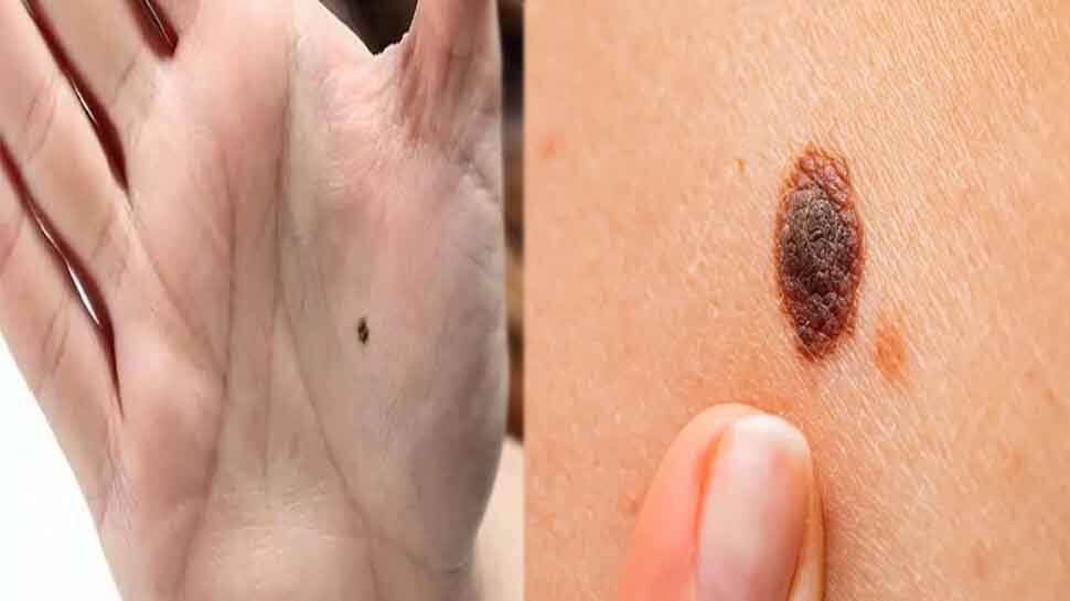 moles on your body parts at this place know benegit means sharir par ...