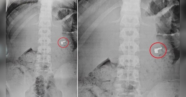 thief swallowed the gold chain snatched from the girl shocking xray ...