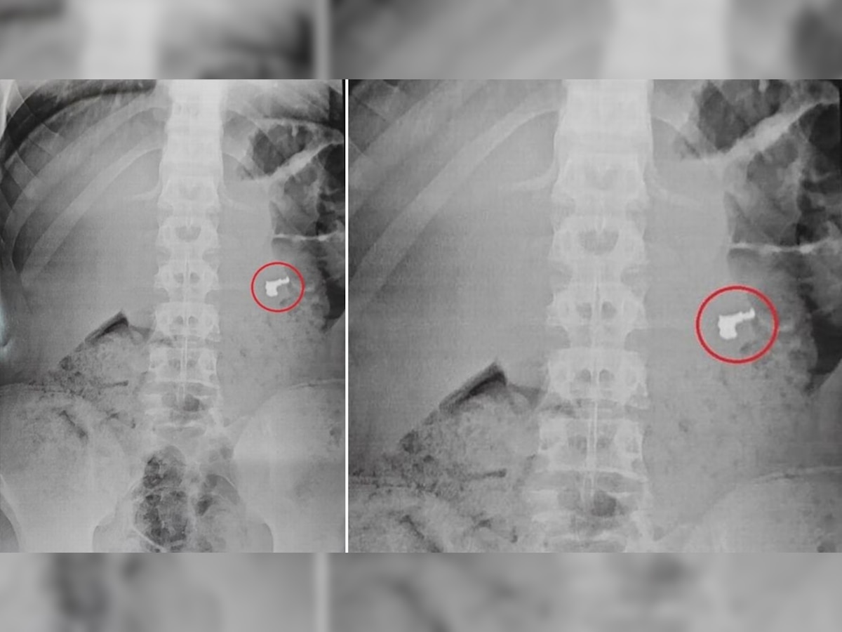 thief swallowed the gold chain snatched from the girl shocking xray ...