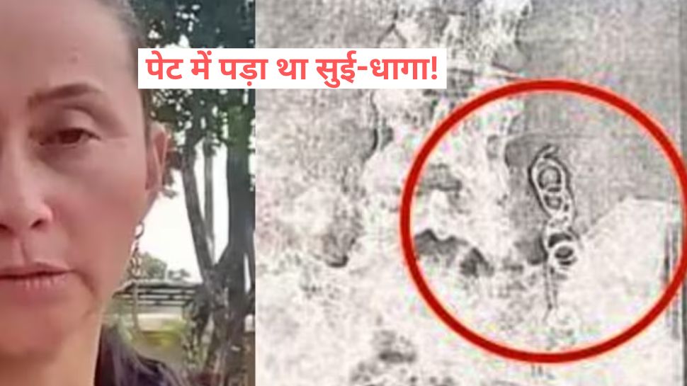 needle thread stuck inside woman stomuch doctors shocked after surgery ...