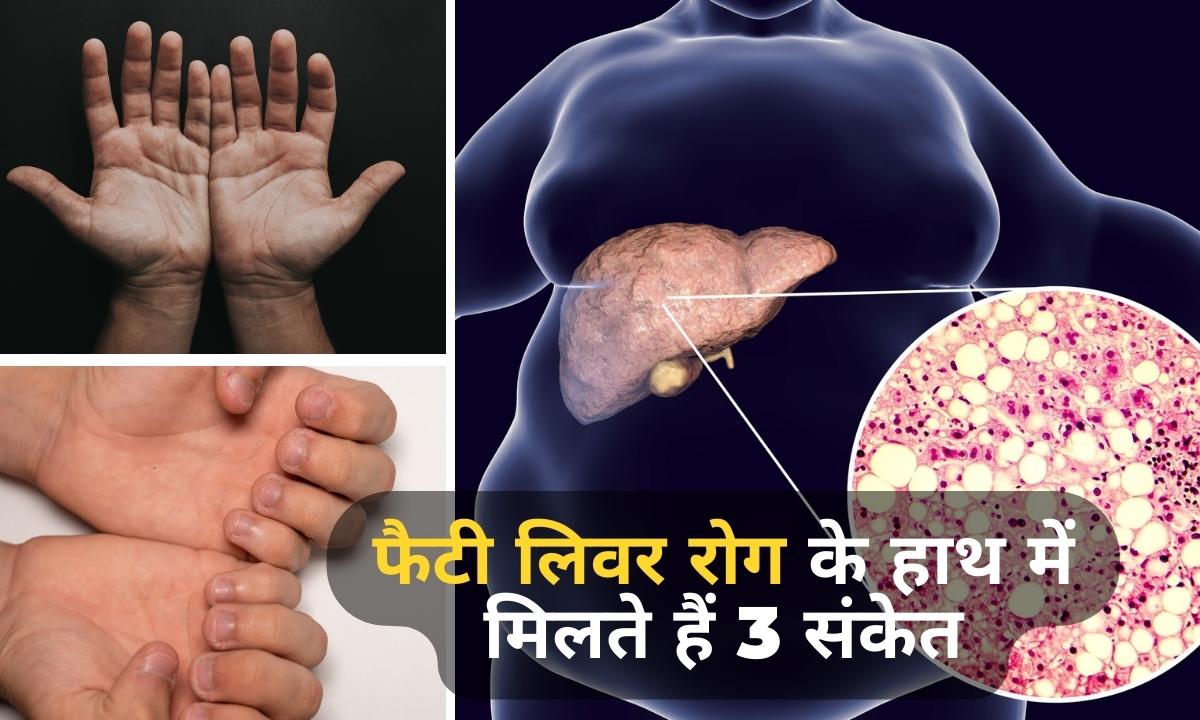 Cirrhosis symptoms: do not ignore these 3 signs on your hands that ...