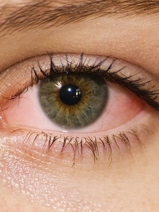 eye care tips how to remove redness of eyes aankho ki jalan dur karne ...