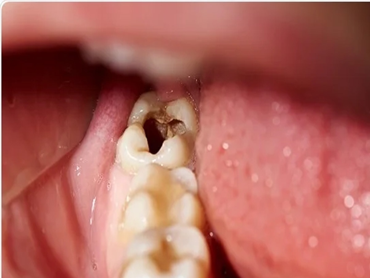 How to get rid of dental problem teeth cavity and all you wants to know ...