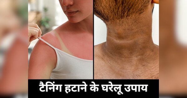 Sun tan removal home remedies to get rid of tanning neck hand and legs ...