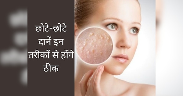 skin care tips home remedies to remove small pimples on face saphed ...