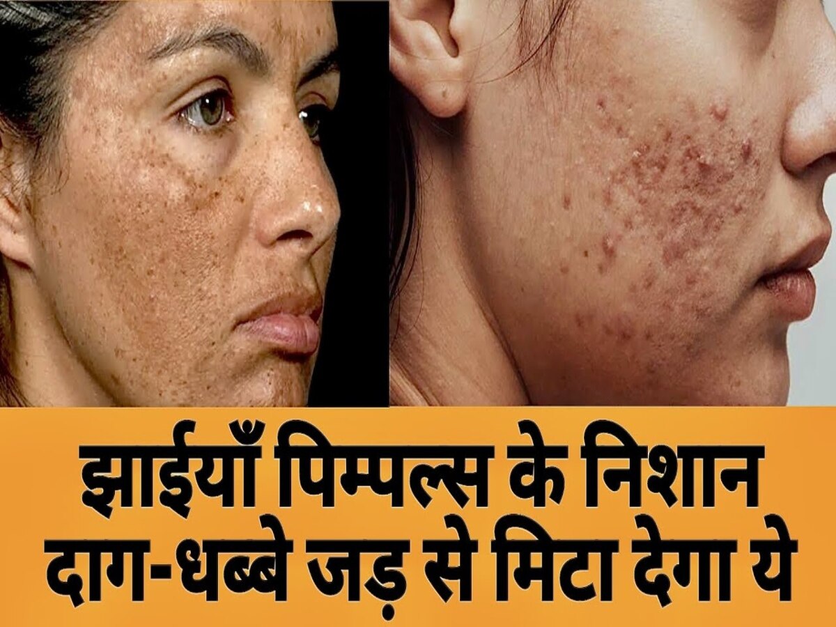 How to Treat Skin pigmentation Naturally Dahi For Clear Skin | Hindi ...