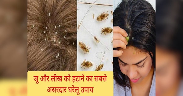 Home Remedies To Get Rid Of Lice Naturally Coconut Oil Camphor Hindi