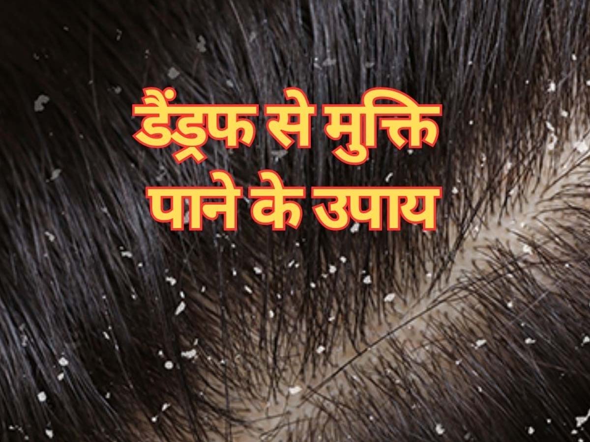 Dandruff Home Remedies how to remove dandruff and avoid Hairfall ...