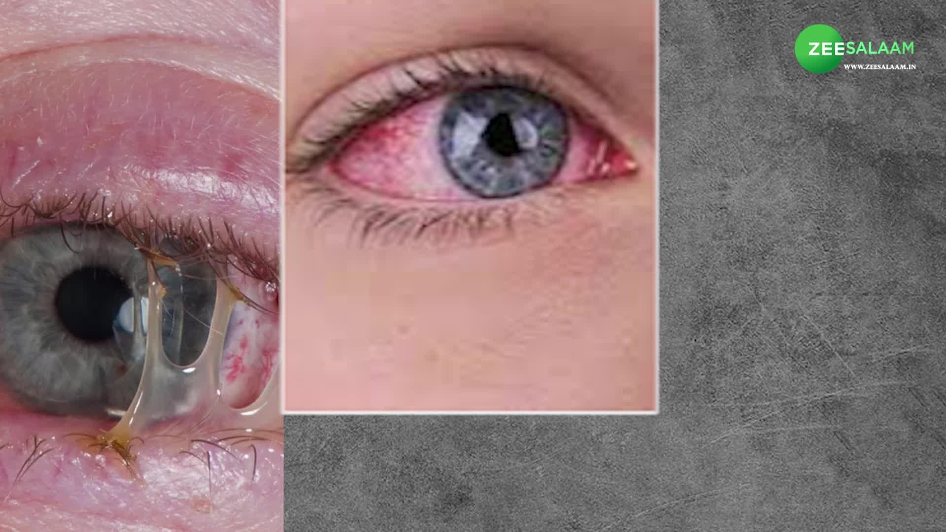 Eye Flu conjunctivitis is spreading in India Causes Symptoms and treatment