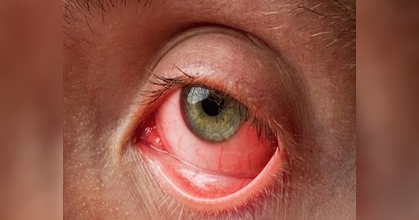 eye flu infection spread know what are symptoms and methods of ...