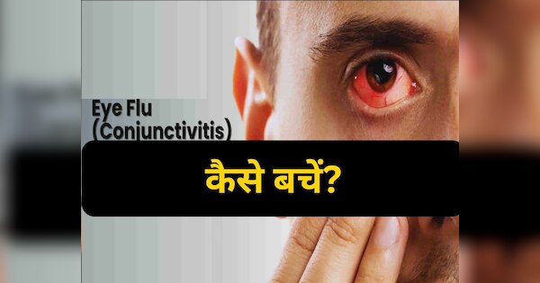 Increase in Hepatitis A and Hepatitis E cases after rains in NCR, eye flu also spread | Eye Flu ...