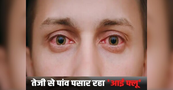 Eye flu spreading rapidly in Bihar victims ranging from children to the ...