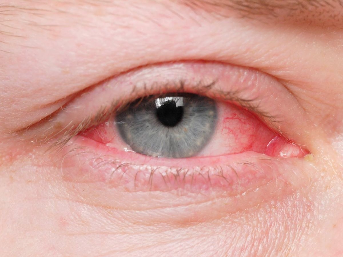 Eye Flu Myth Busters does eye flu spread by looking in hindi kya dekhne ...