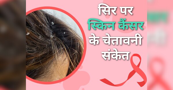 Warning signs of skin cancer are also visible in head do not be ...
