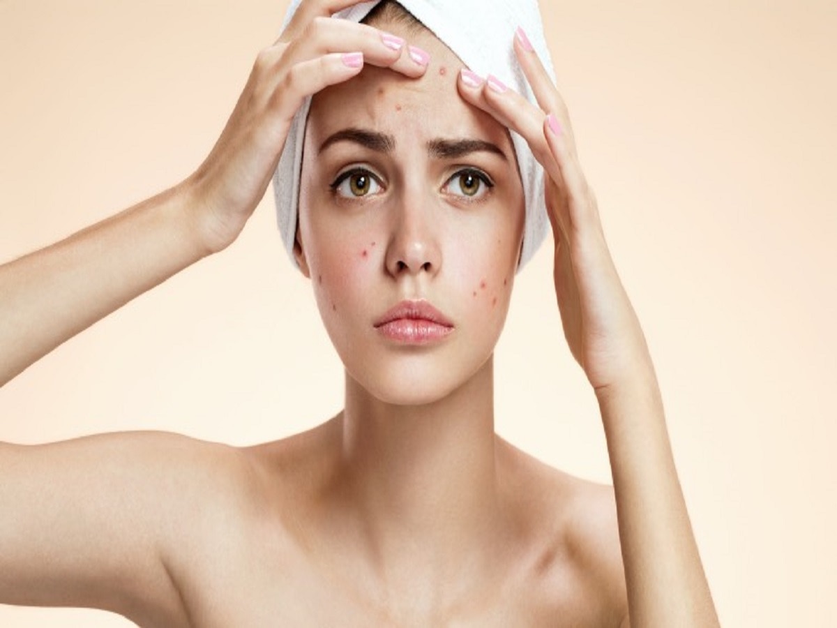 This Home Remedy Will Get Rid Of Pimples Make Your Face more Beautiful
