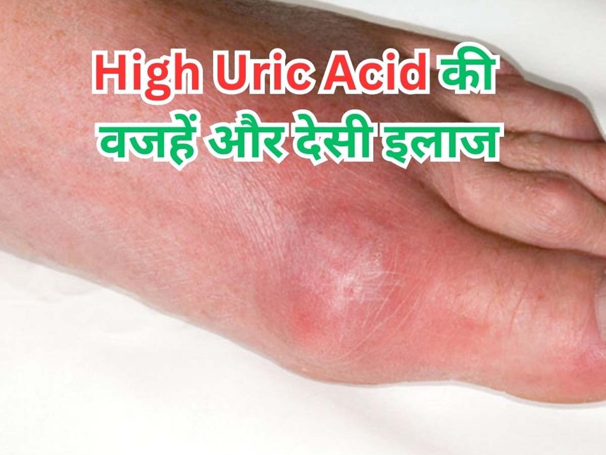 High Uric Acid Causes and Remedies how to control High uric acid | High ...