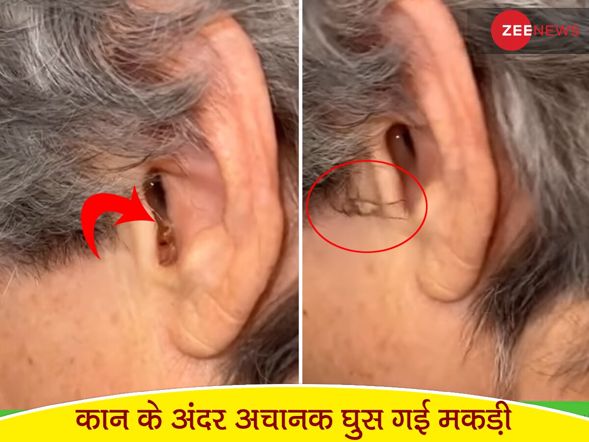 Suddenly spider enter in the ear doctor treatment will shock you watch ...
