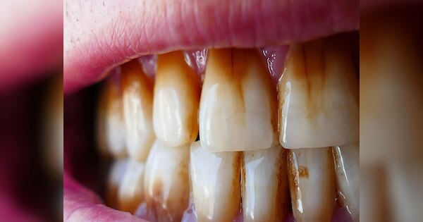lifestyle news Remove yellowing of teeth with these easy home remedies ...