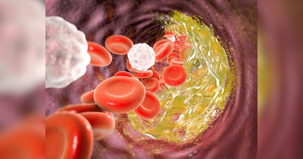 5 ayurvedic remedies will help to remove bad cholesterol from the body ...