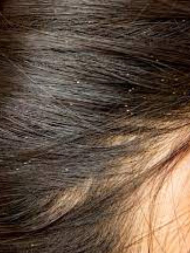 best home Desi remedy for lice in head baalon me ju kaise khatm karen