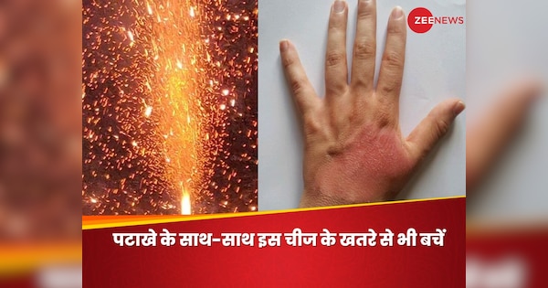Diya And Candles Causes More Fire Burn Death Than Crackers During ...