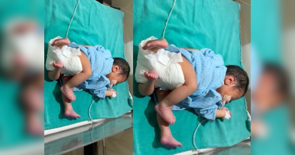 Child with four arms and four legs was born in Muzaffarnagar undergoing ...